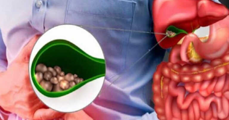 O que causa pedra na vesícula? Conheça os sintomas e como eliminar ...