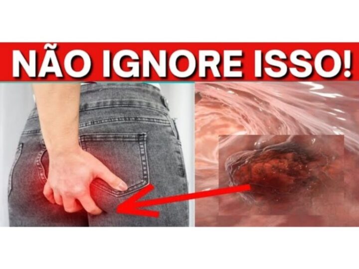 SINAIS e SINTOMAS de CÂNCER DE INTESTINO (colón), que podem SALVAR SUA ...